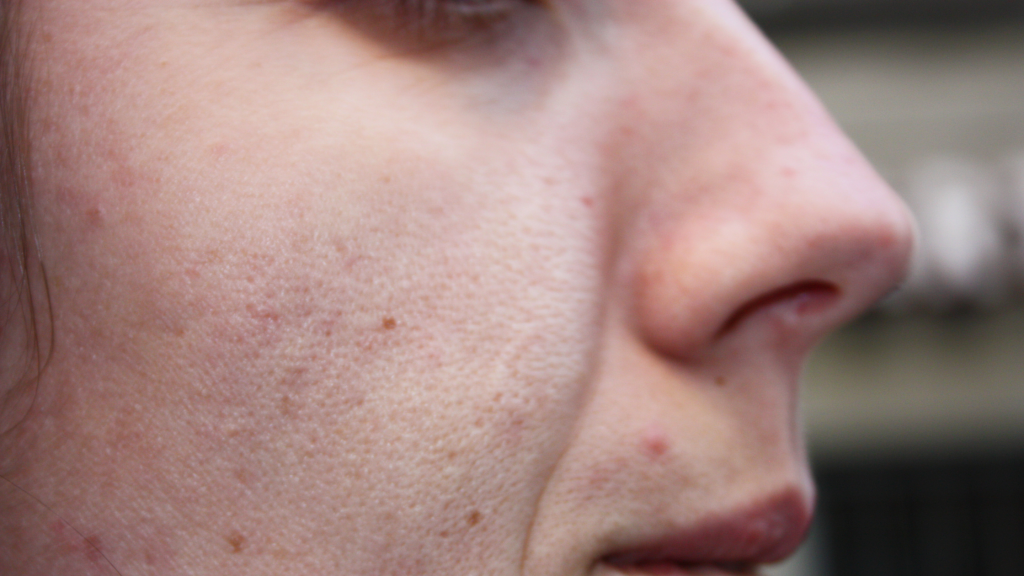 How Does A Laser Treatment Work? - Metrolina Medical Associates